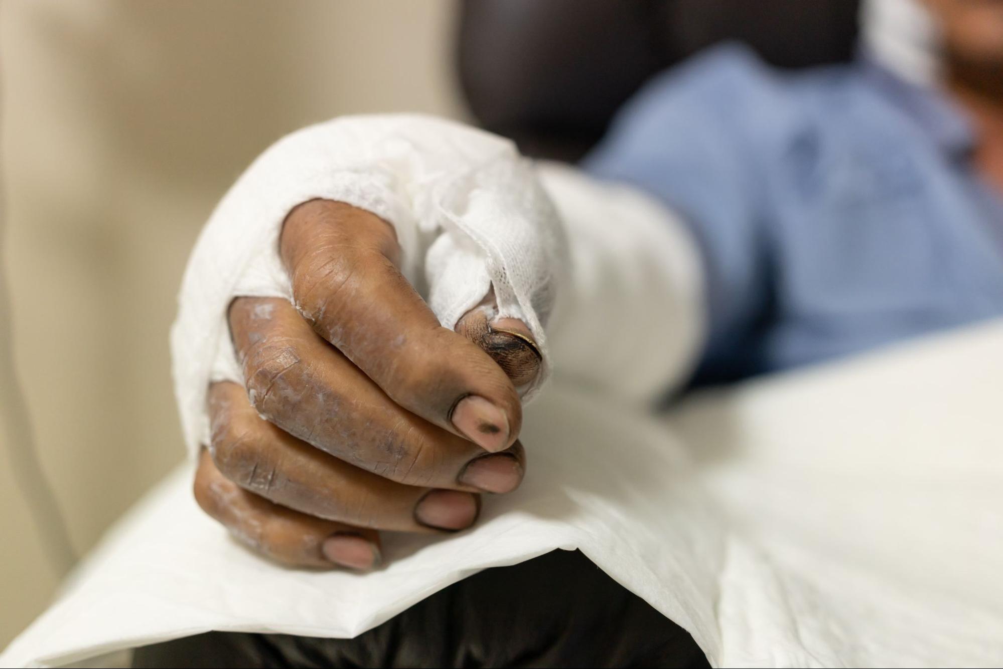 Burn Injuries Common Work Industries | Bachus & Schanker